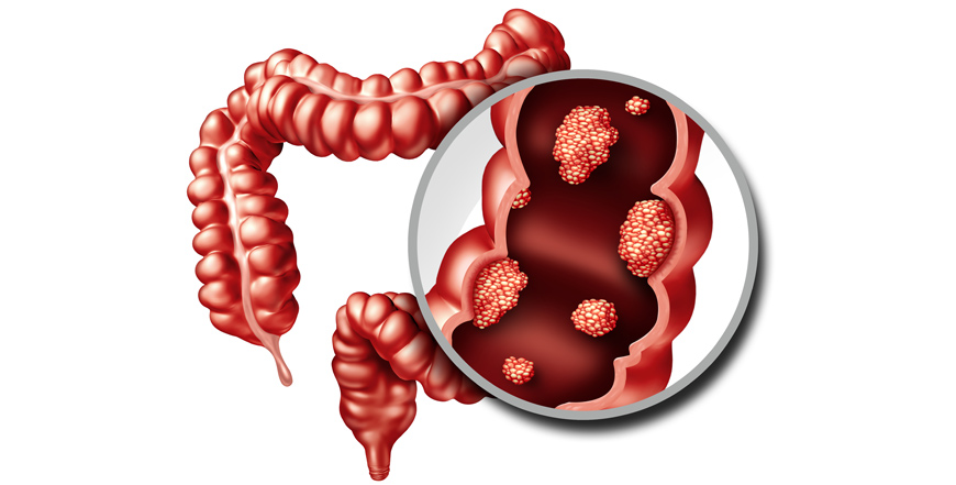 Πολύποδες & Καρκίνος του Παχέος Εντέρου - Δημήτρης Τσάμης