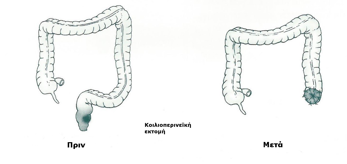 Κολεκτομή - Λαπαροσκοπική Αφαίρεση Παχέος Εντέρου - Δημήτρης Τσάμης